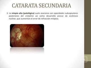 Cataratas | PPTX