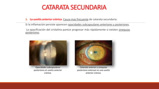 Cataratas - Oftalmología | PPTX