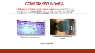 Cataratas - Oftalmología | PPTX