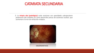 Cataratas - Oftalmología | PPTX