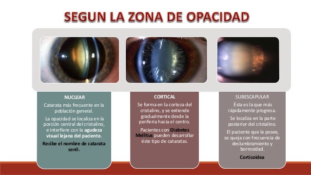 Cataratas - Oftalmología