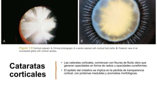 Bases Fisiologicas de las Cataratas Oftalmologia .pptx