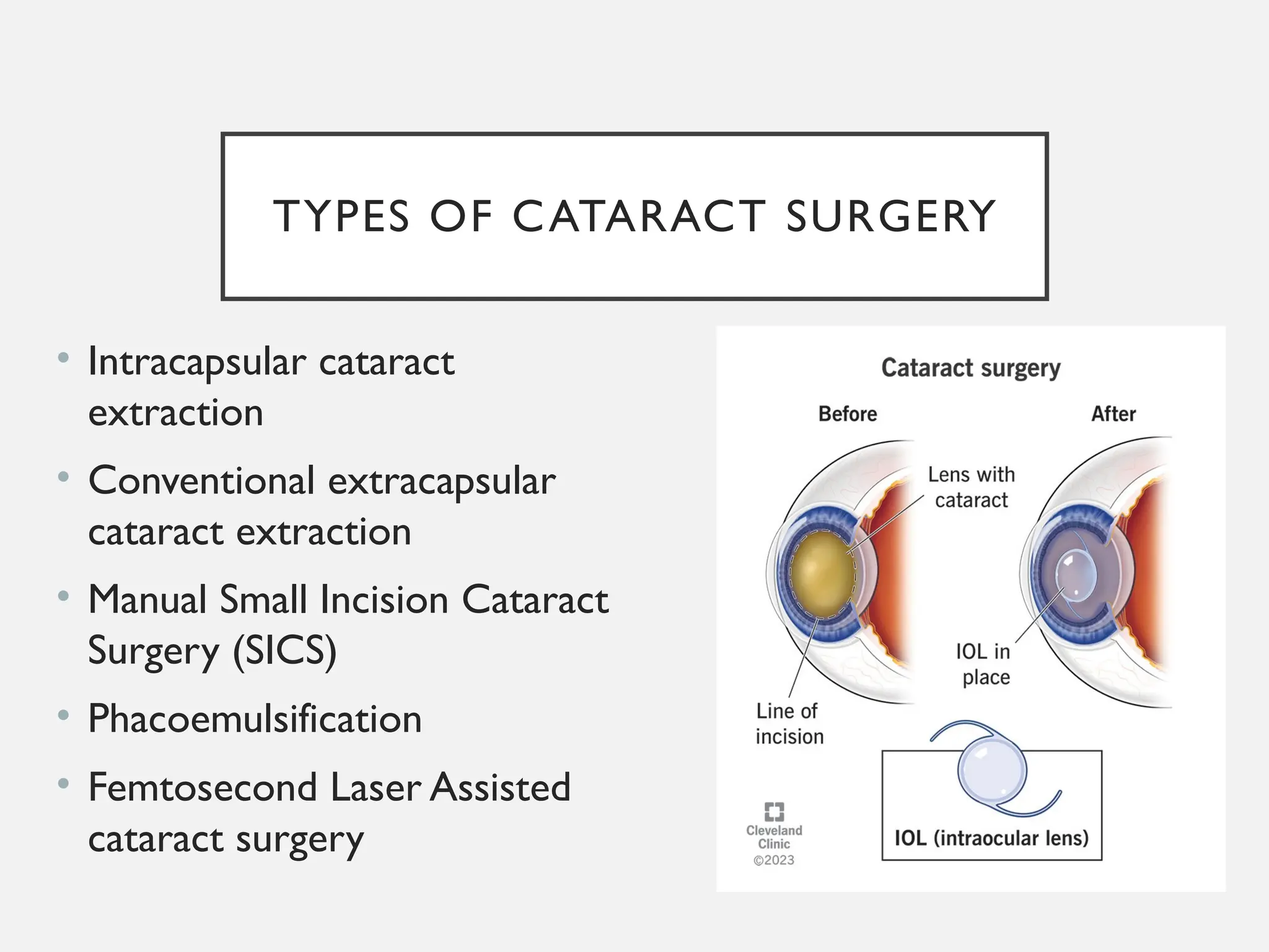 Type of Catarct surgery icce and ecce.pptx