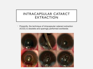 Type of Catarct surgery icce and ecce.pptx
