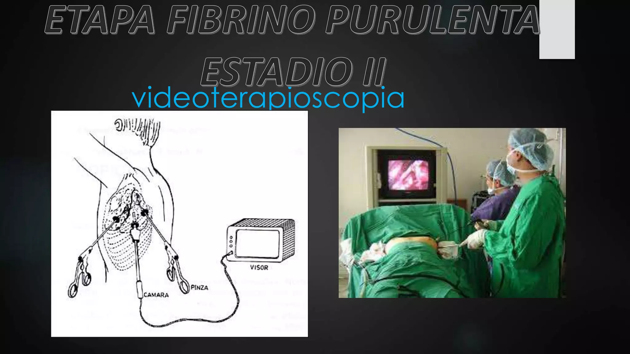 Catedra de cirugia cardiovascular EMPIEMA PLEURAL | PPTX | Lung and ...