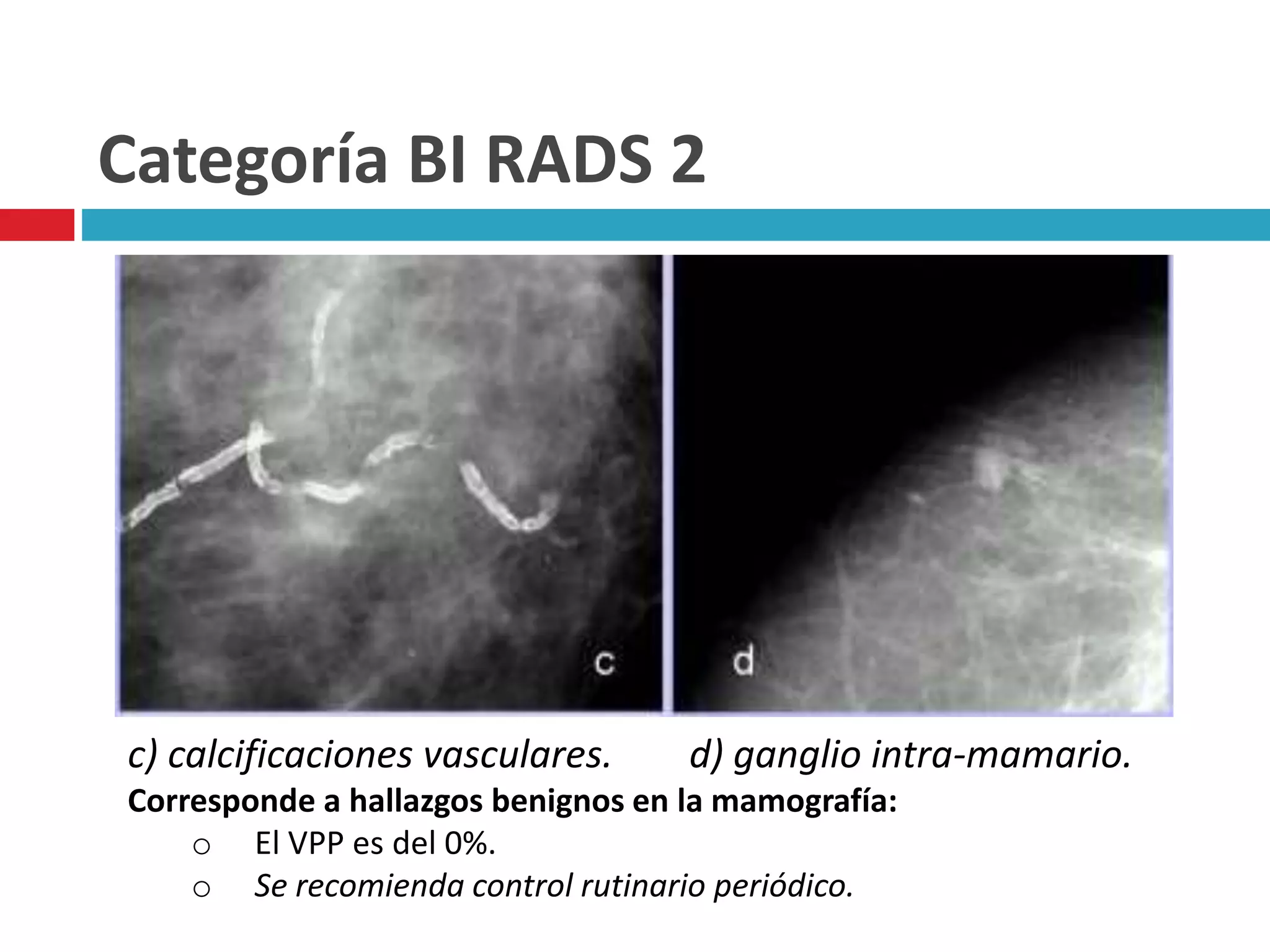 Categorías bi rads en los informes mamográficos | PPTX