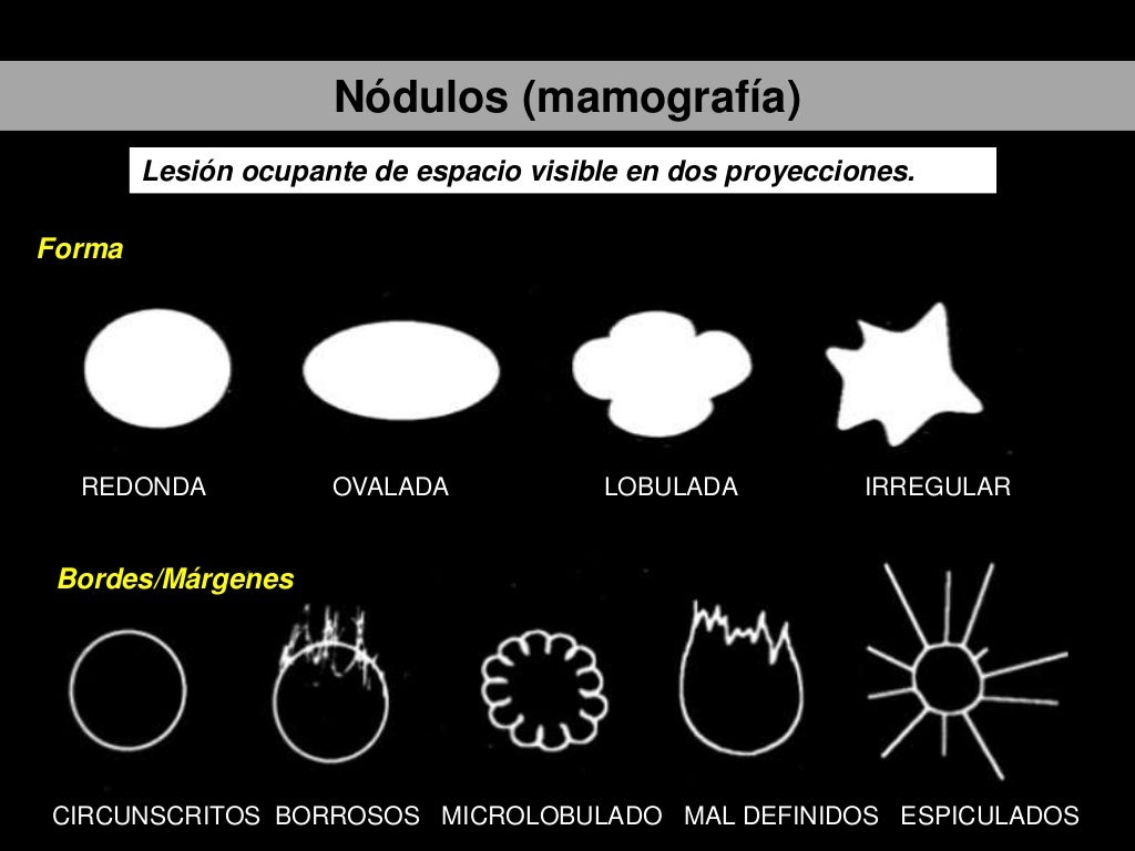 Nódulo Lobulado Birads 4 - RETOEDU