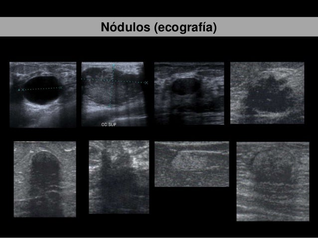Sesión: Clasificación BIRADS