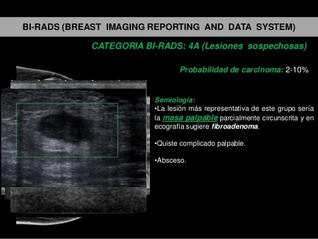 Bi Rads 4a