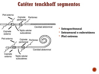 Catéter de tenckhoff tecnica y anatomia de pared.pptx