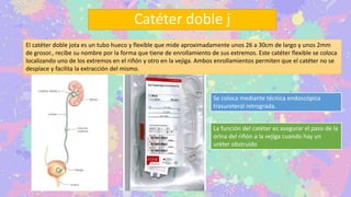 cateter doble J.pptx
