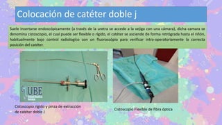 cateter doble J.pptx