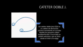 Colocación catéter doble J urología..... | PPTX