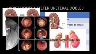 Colocación catéter doble J urología..... | PPTX