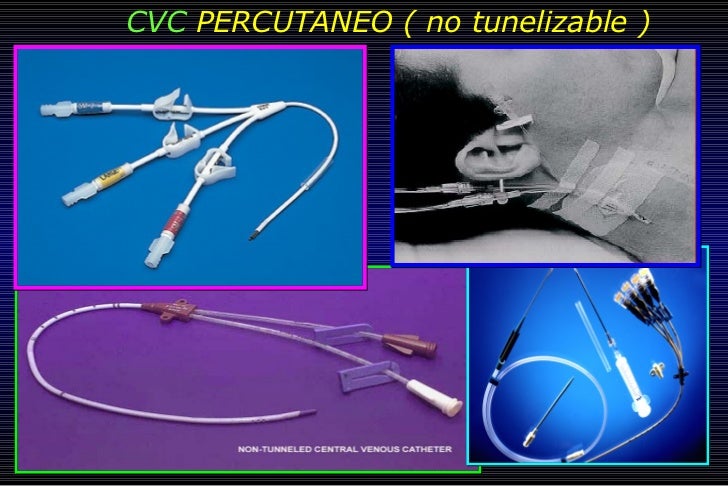 Non Tunneled Central Venous Catheter