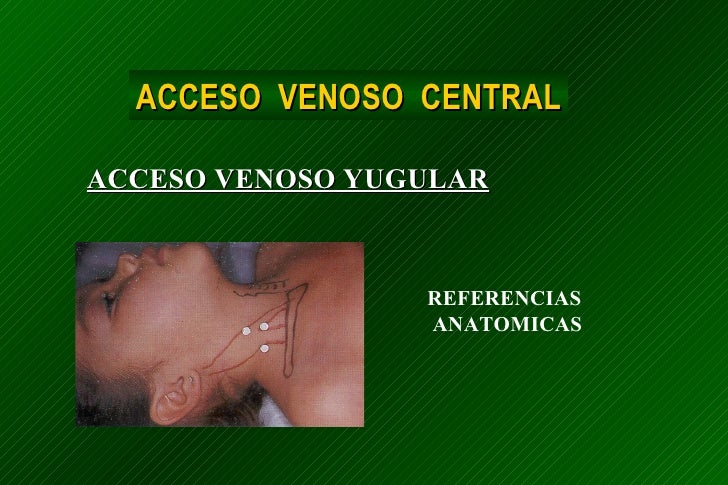 Cateterismo Central En NiñOs