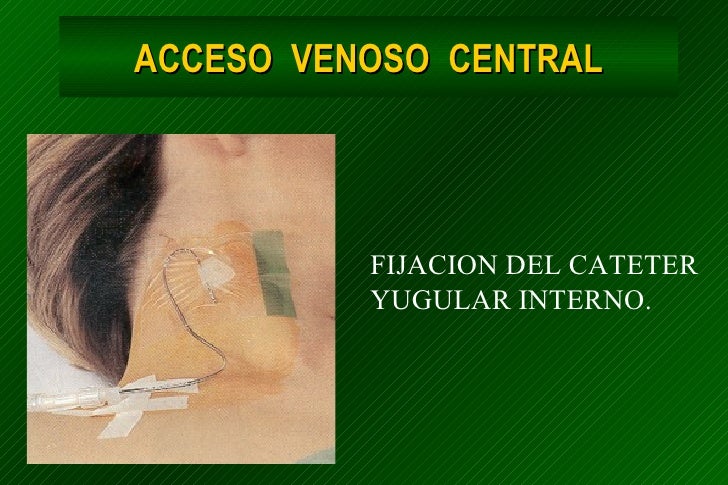 Cateterismo Central En NiñOs