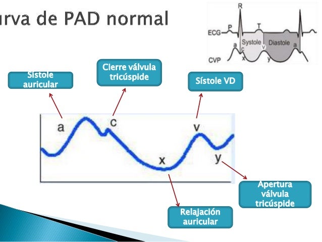 Cateterismo derecho: Catéter de Swan-Ganz. Indicaciones, vías de acce…