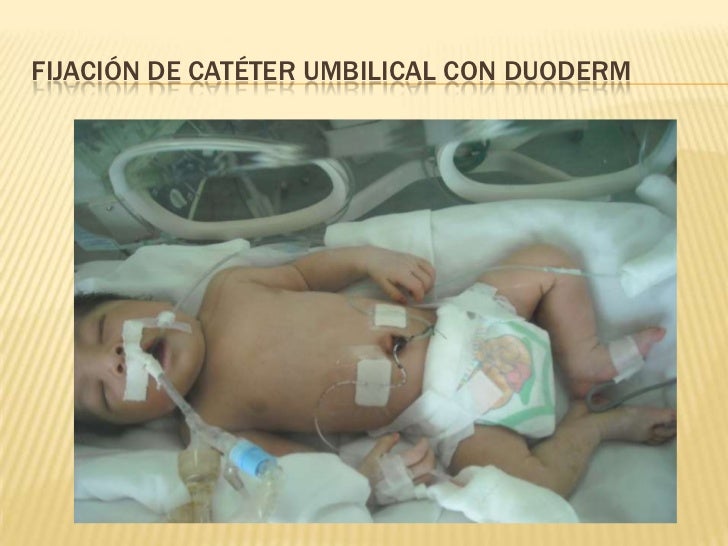 Cateterismo Umbilical