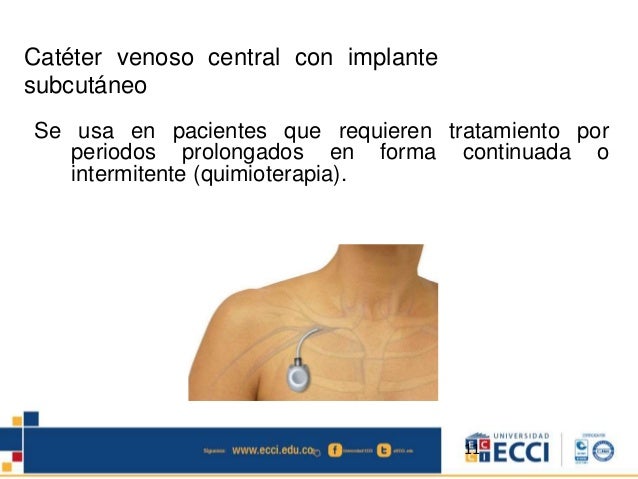 Cateter venoso central