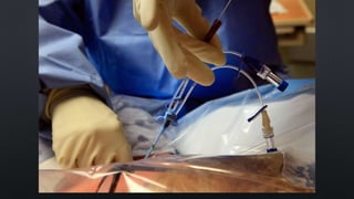 Catéter venoso central.pptx