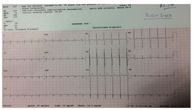 CATH MEET: POST GLENN FOR RAISED PA PRESSURES | PPT
