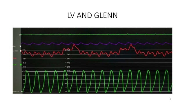 CATH MEET: POST GLENN FOR RAISED PA PRESSURES | PPT
