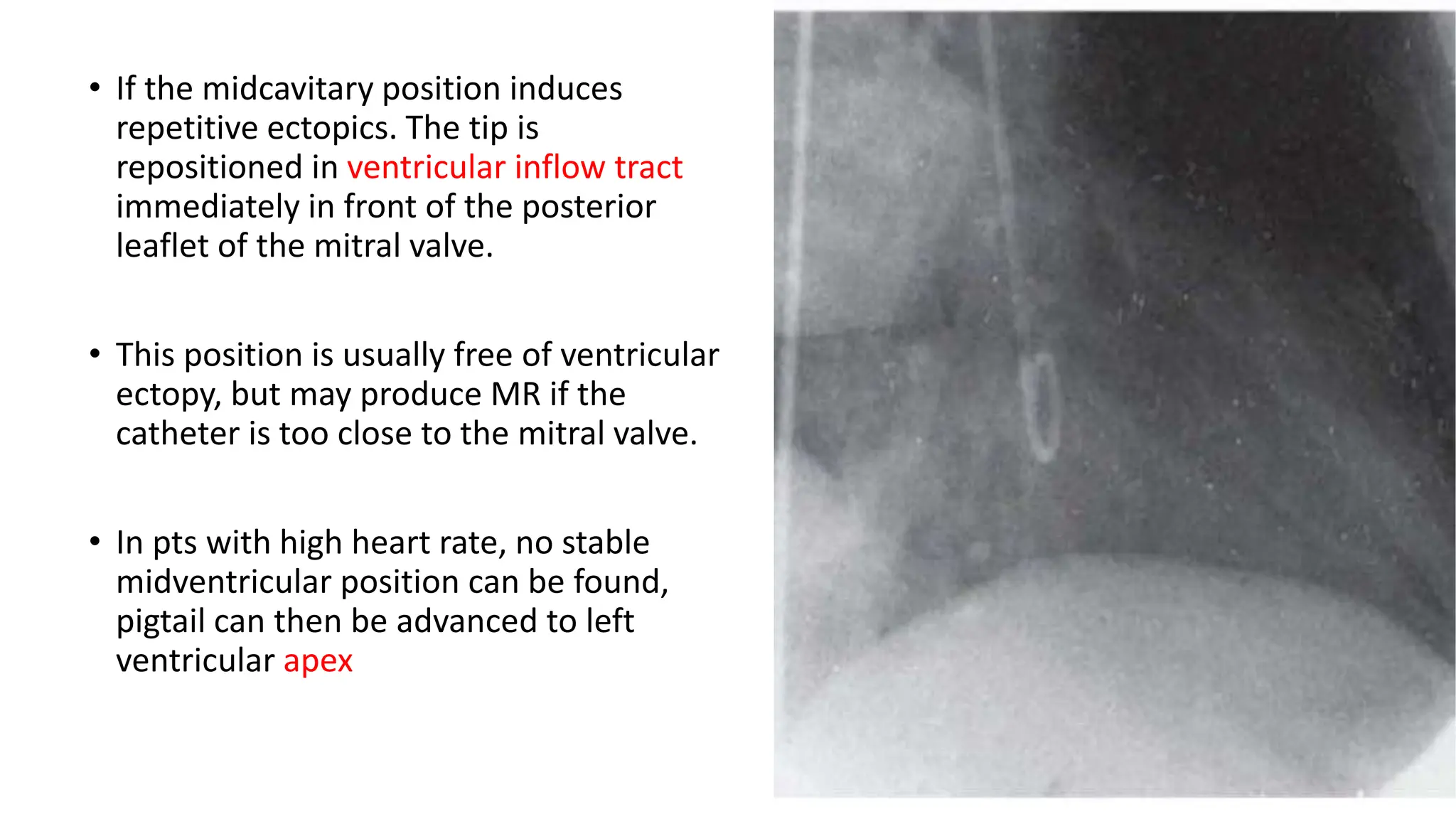LV angiography.pptx