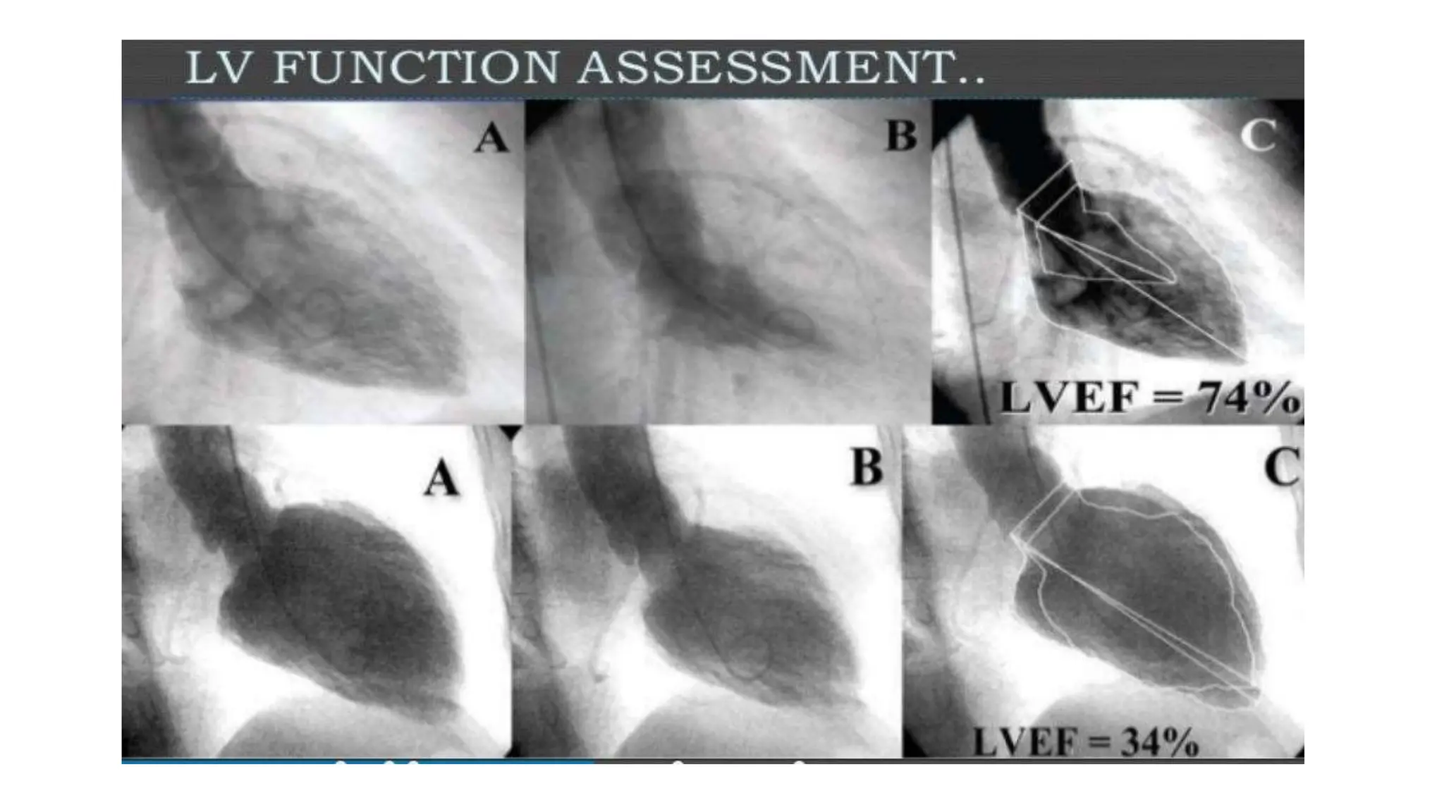 LV angiography.pptx
