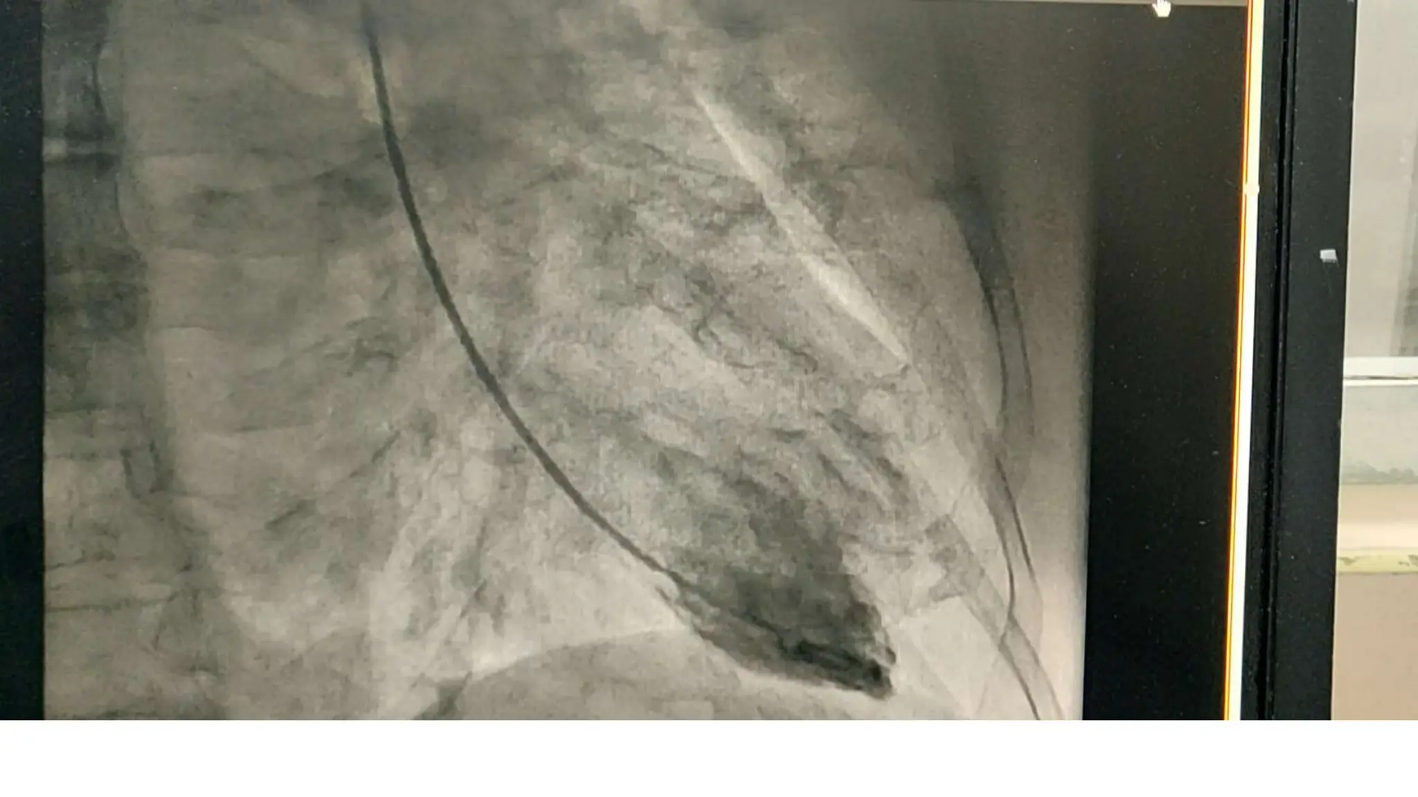 LV angiography.pptx