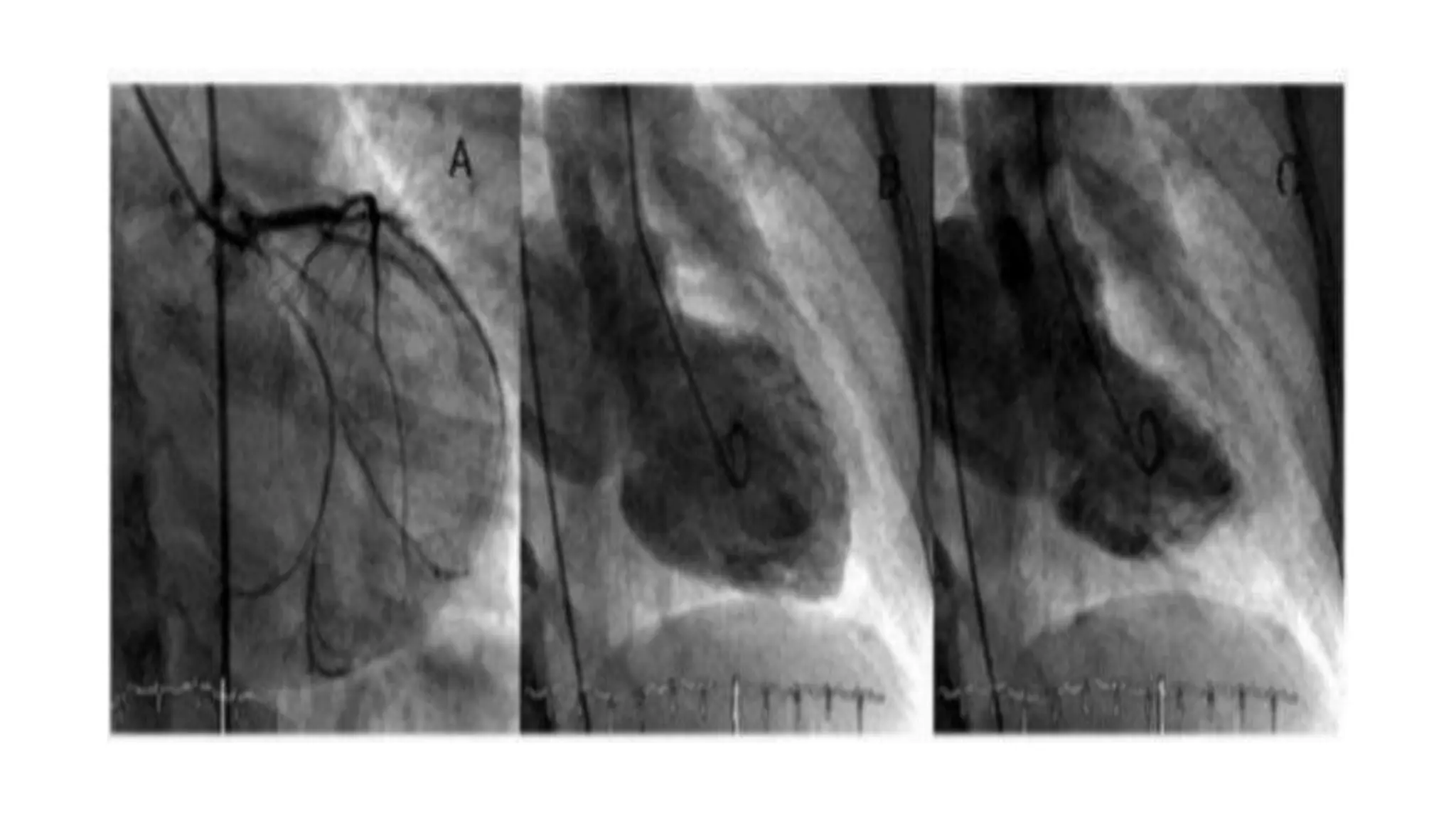 LV angiography.pptx