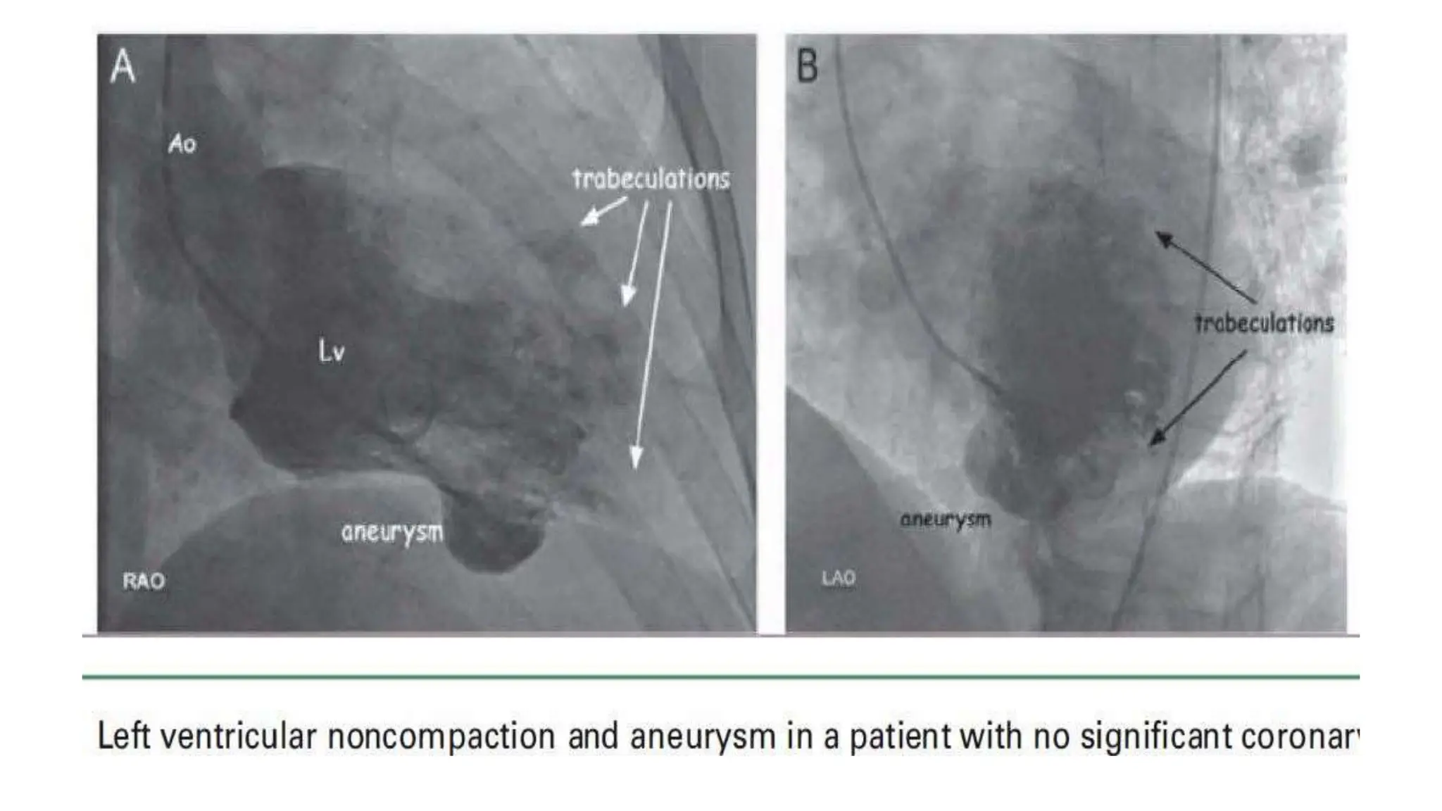 LV angiography.pptx