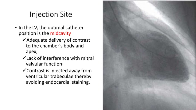 LV angiography.pptx | Heart and Cardiovascular Diseases | Diseases and ...