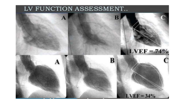 LV angiography.pptx | Heart and Cardiovascular Diseases | Diseases and ...
