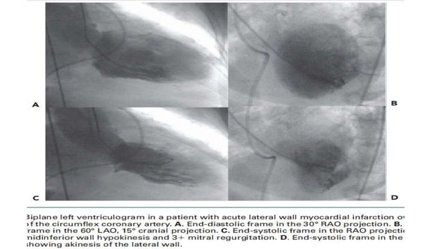 LV angiography.pptx | Heart and Cardiovascular Diseases | Diseases and ...