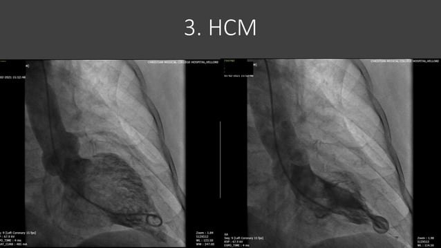 LV angiography.pptx | Heart and Cardiovascular Diseases | Diseases and ...