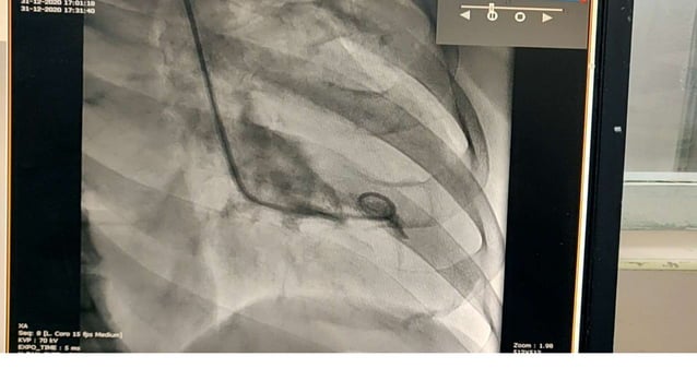 LV angiography.pptx | Heart and Cardiovascular Diseases | Diseases and ...