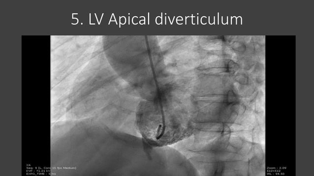 LV angiography.pptx | Heart and Cardiovascular Diseases | Diseases and ...