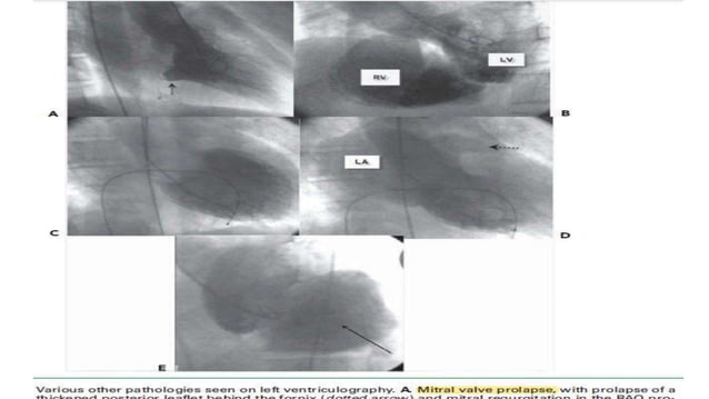 LV angiography.pptx | Heart and Cardiovascular Diseases | Diseases and ...