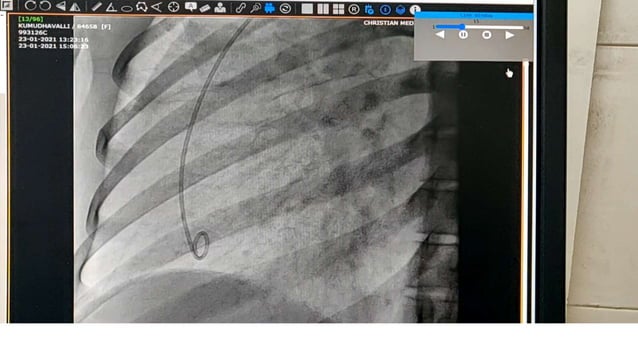LV angiography.pptx | Heart and Cardiovascular Diseases | Diseases and ...