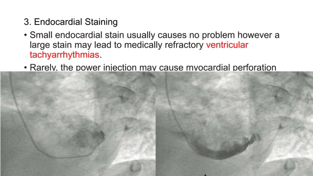 LV angiography.pptx | Heart and Cardiovascular Diseases | Diseases and ...