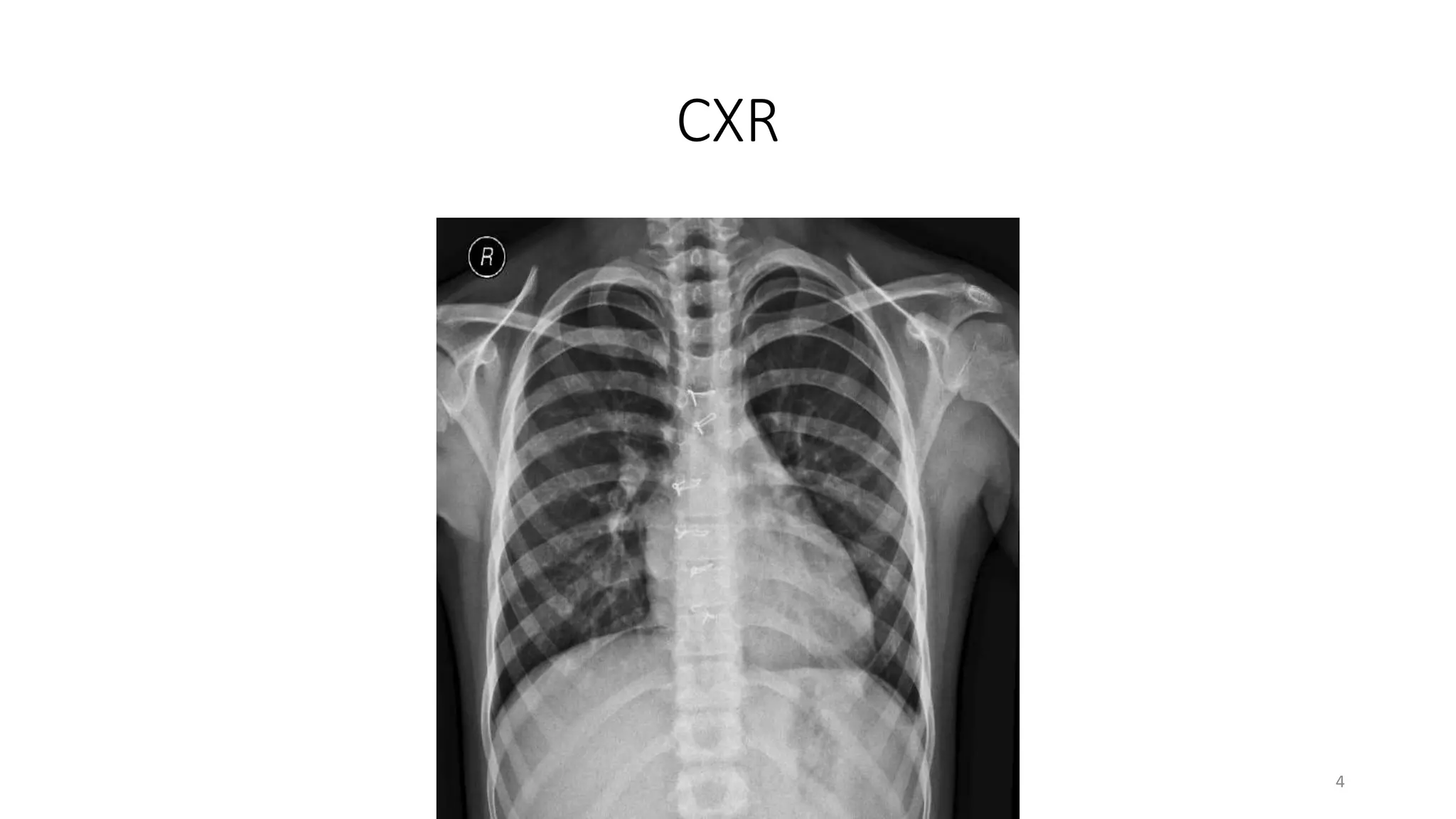CATH STUDY: PRE FONTAN CATH | PPTX