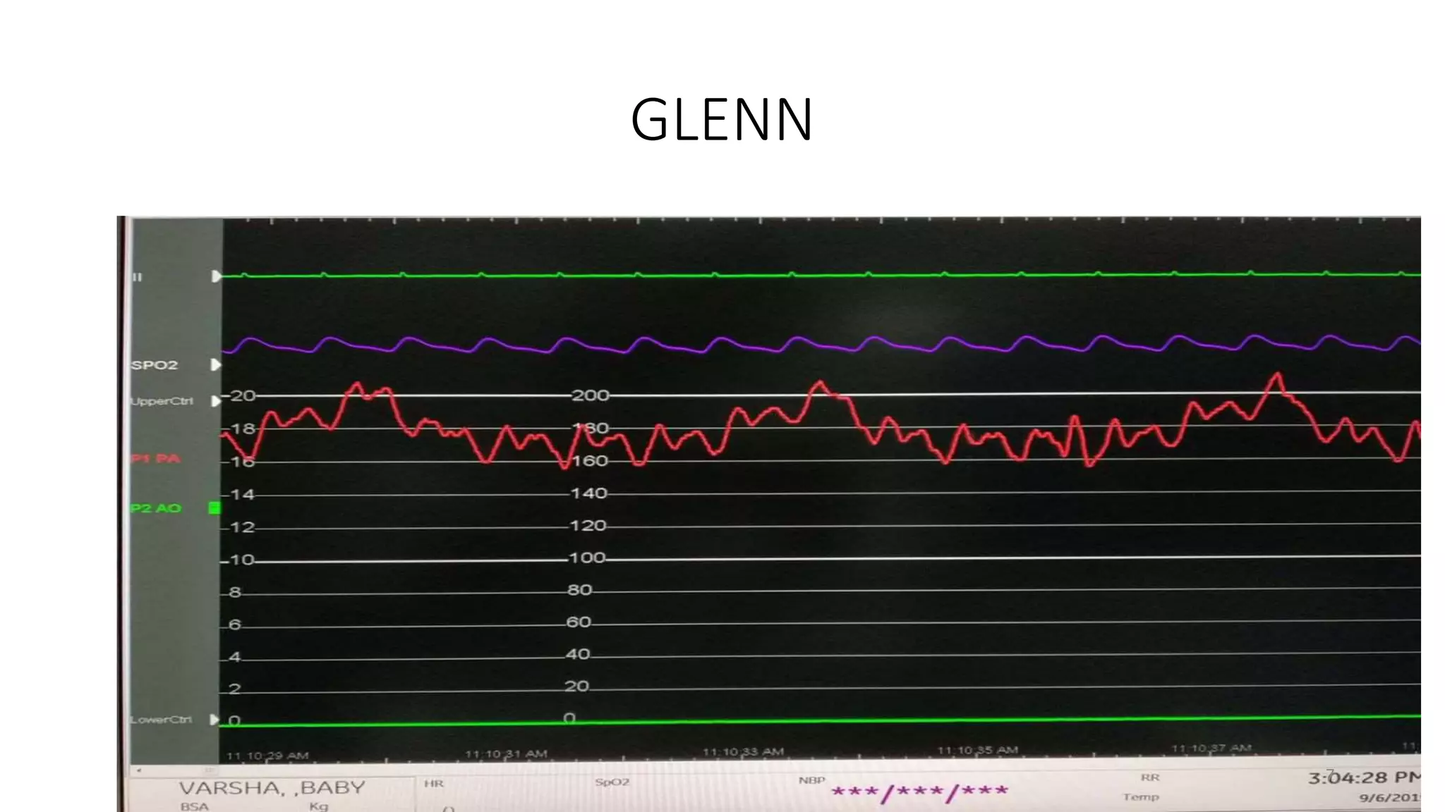 CATH STUDY: PRE FONTAN CATH | PPTX