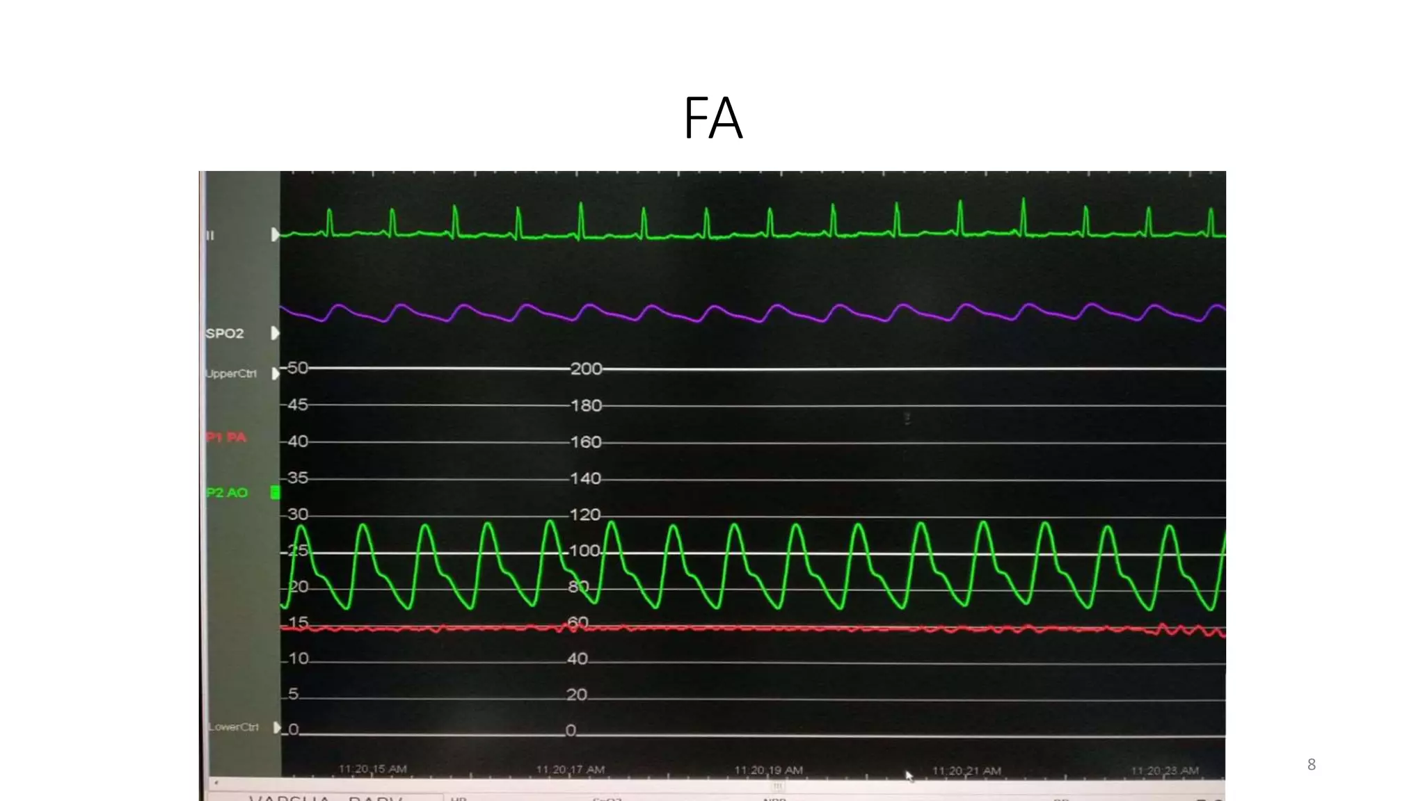 CATH STUDY: PRE FONTAN CATH | PPTX