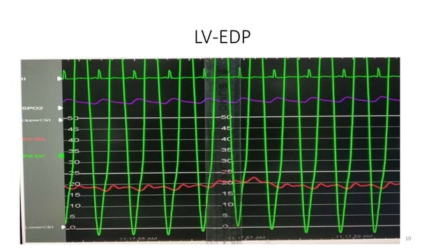 CATH STUDY: PRE FONTAN CATH | PPT