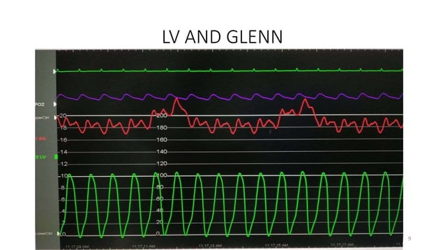 CATH STUDY: PRE FONTAN CATH | PPT
