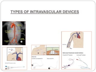 Catheter related blood stream nanoti sir | PPTX