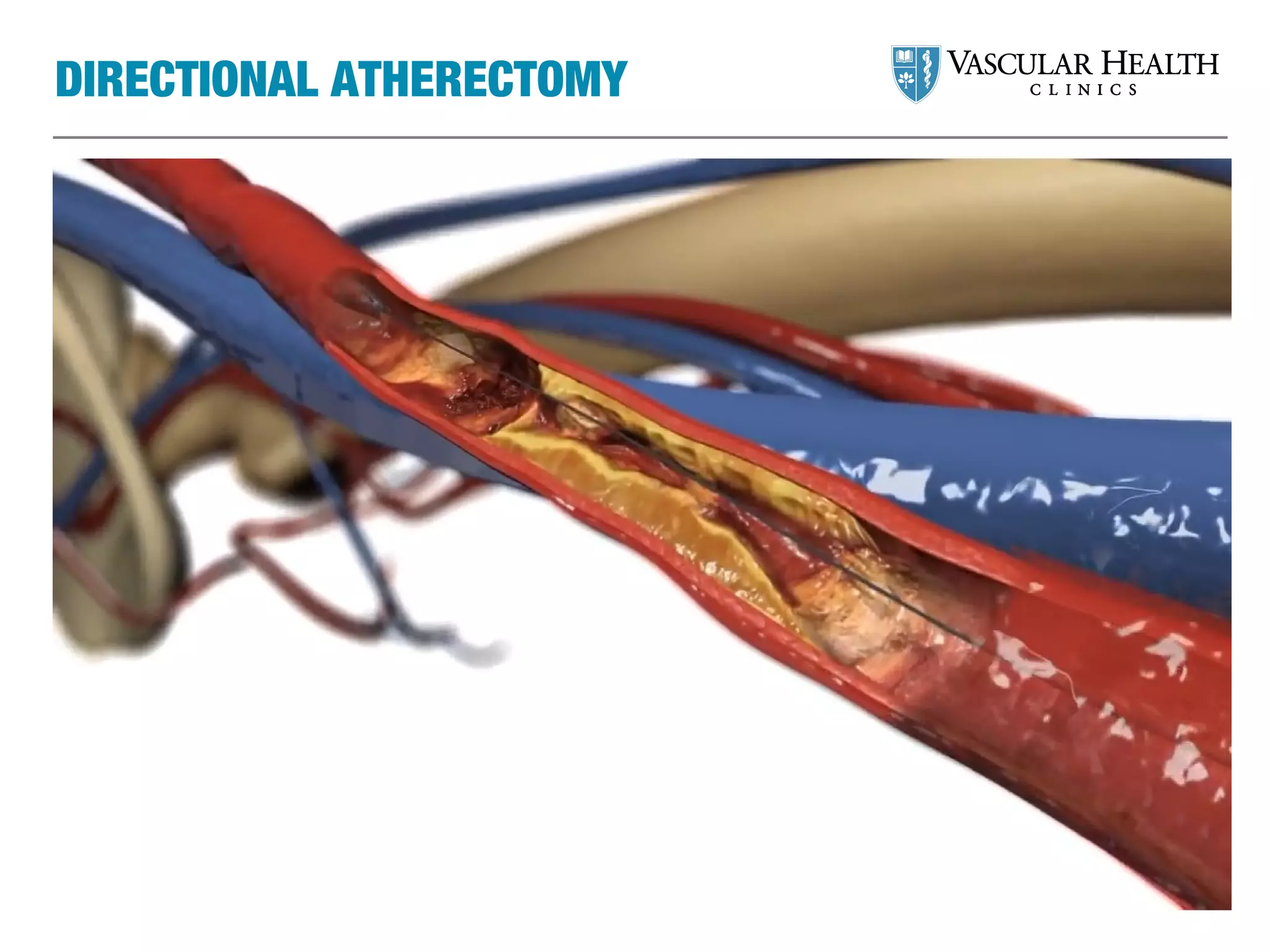 Catheter Based Intervention and Surgical Management of Peripheral ...