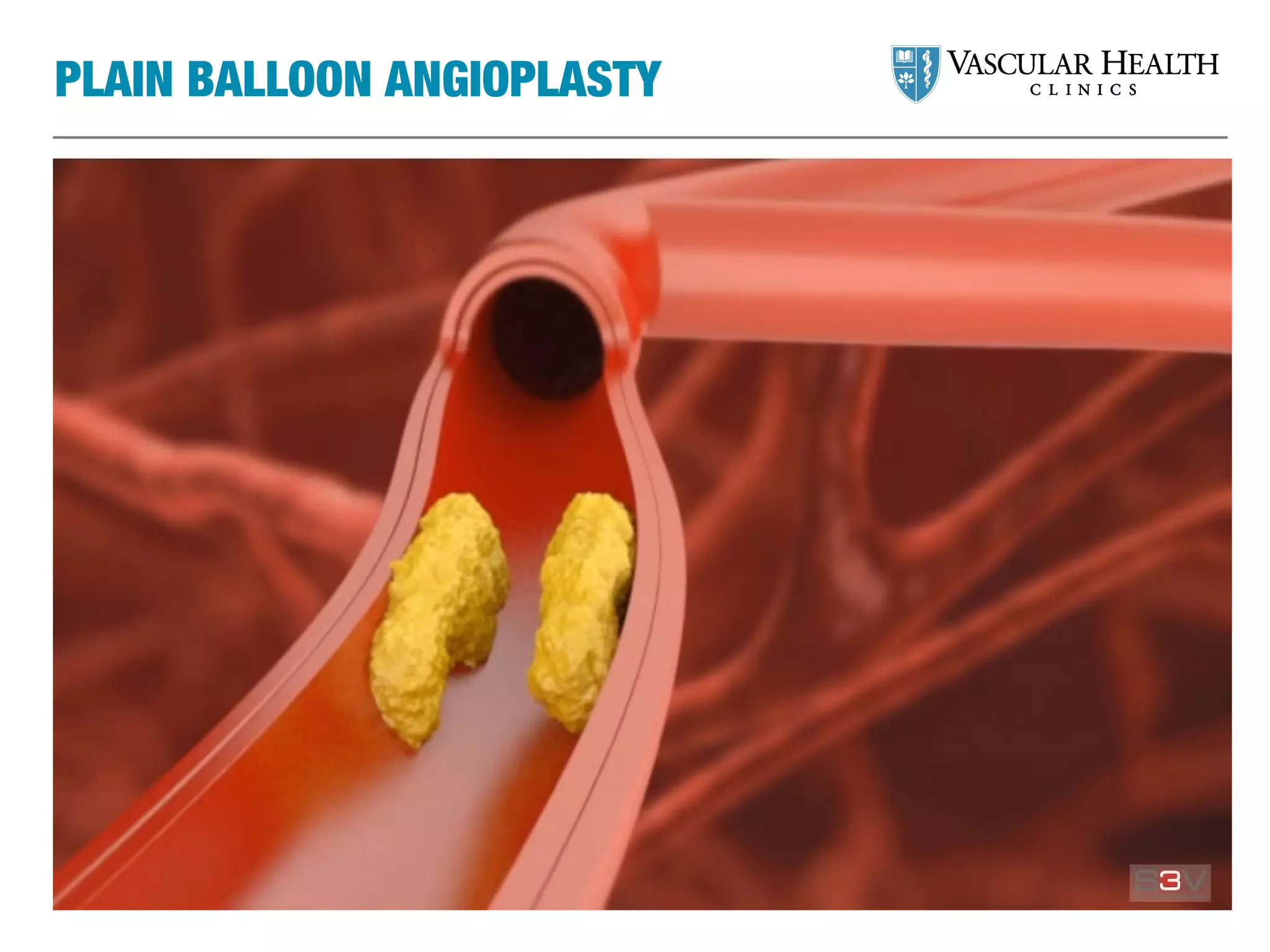 Catheter Based Intervention and Surgical Management of Peripheral ...