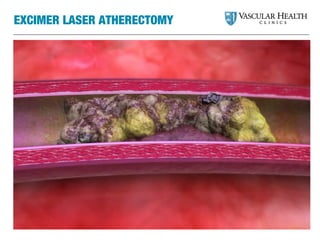 Catheter Based Intervention and Surgical Management of Peripheral ...